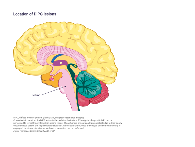 DIPG disease overview - MEDhub US