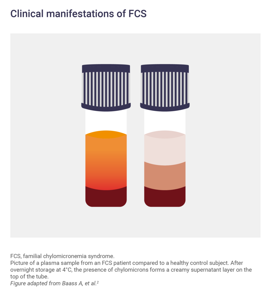 Familial chylomicronemia syndrome (FCS) disease overview - MEDhub